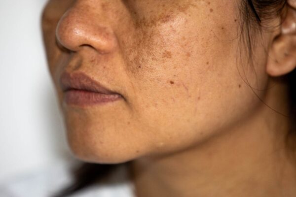 Skin related medicals in the Merchant Navy - Merchant Navy Decoded